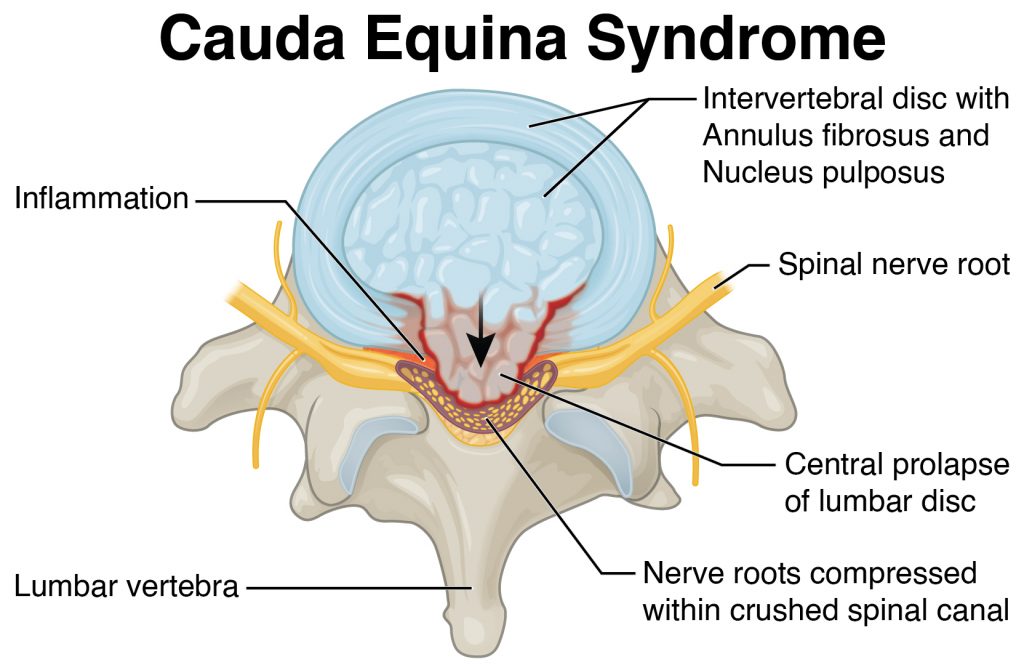 Cauda Equina Syndrome – C. Jones and Associates, LLC
